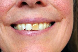7 Reasons You Might Have Yellow Teeth | West Mississauga Dental